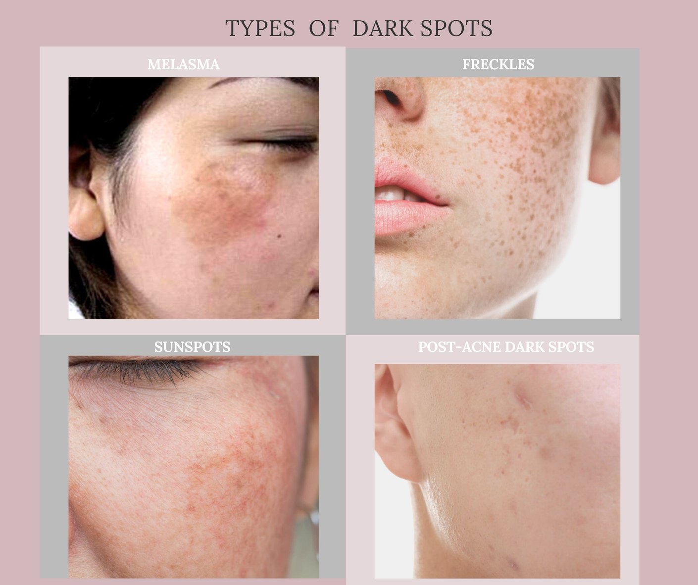 How to fight Dark Spots, Blemishes and Splotchy Skin